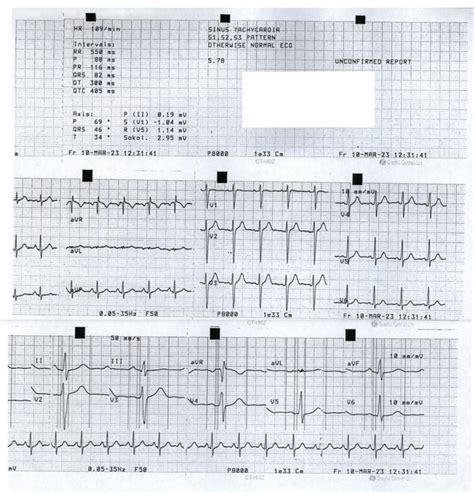 Sinus Tach With S1s2s3 Effect Any Ideas Doesnt Seem To Be Well