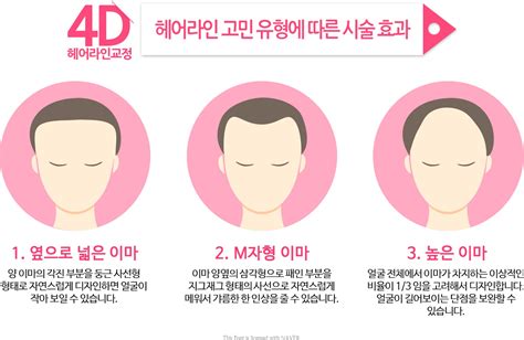 Hair Transplant Blog 여성m자 헤어라인 이마교정에 대해 알아봅시다