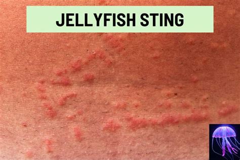Red Lines On The Skin Causes Pictures Treatment
