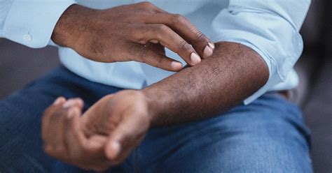 Finkelstein Test Purpose Technique And What Results Mean