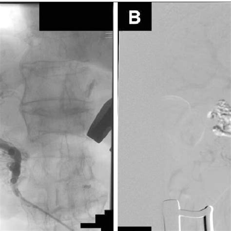 Intraoperative Angiographies A Before Embolization B After