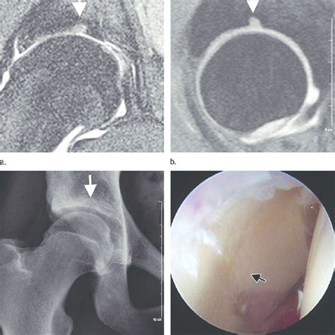 Pdf Supraacetabular Fossa Pseudodefect Of Acetabular Cartilage Frequency At Mr Arthrography