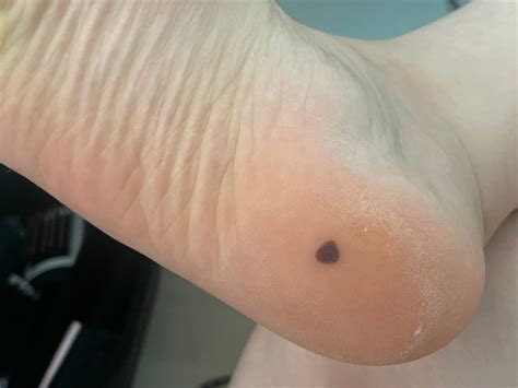 갑자기 생긴 발바닥 큰 점 지식in