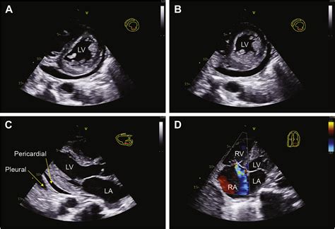 Point Of Care Ultrasound In An Unstable Patient After Cardiac Surgery