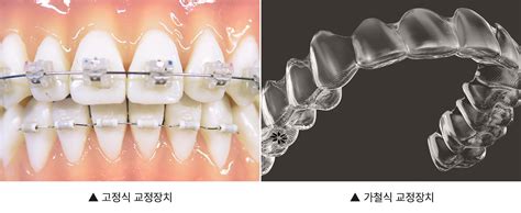 교정 전문의가 알려주는 치아교정 종류와 선택 기준 리스트 닥터나우