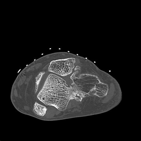Radiopaedia Case Subtalar Joint Injection Ct Guided Id 77262 Study