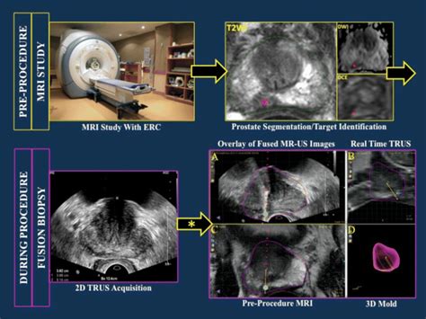 What Is The Fusion Guided Prostate Biopsy