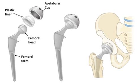Joint Replacement Design In Discovery Education Resources