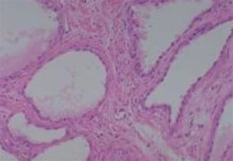 Novus Biologicals Human Prostate Tissue Microarray Cancer Human