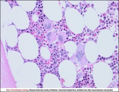 Essential Thrombocythaemia Et Cell Atlas Of Haematological Cytology