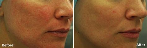 Morpheus 8 Before And After Real Patient Results