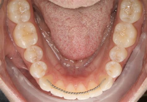 Post Op Instructions Orthodontic Retainers