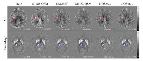 axial views of quantitative susceptibility mapping qsm