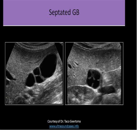 Biliary Flash Card Flashcards Quizlet