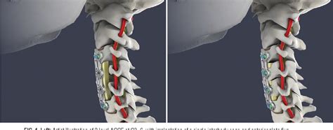 Figure 1 From Two Level Corpectomy Versus Three Level Discectomy For