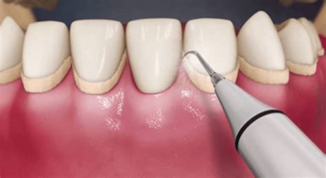 ultrasonic scaling dental clinic in dhaka bangladesh prof dr