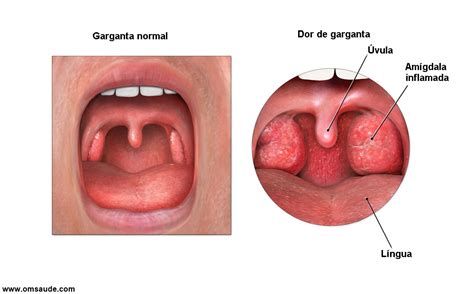 Como Fechar As Criptas Das Amígdalas Braincp