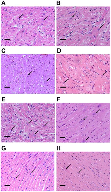 Histopathological Evaluation Of Myocardial Disarray In Left Ventricles