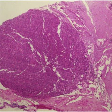 Low Power View 4× Hande Showing Well Circumscribed Nodule Consisting Download Scientific