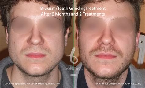 Botox For Bruxism Before And After Pictures Botonics