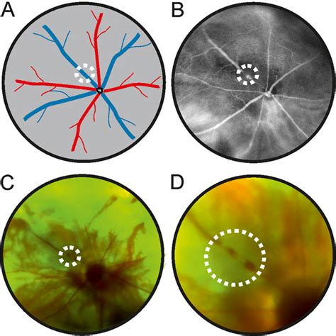 Venous Stasis Retinopathy