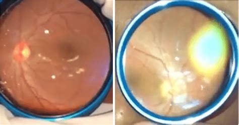 Right Eye Fundus After Recovery Shows Left Eye Fundus After Recovery