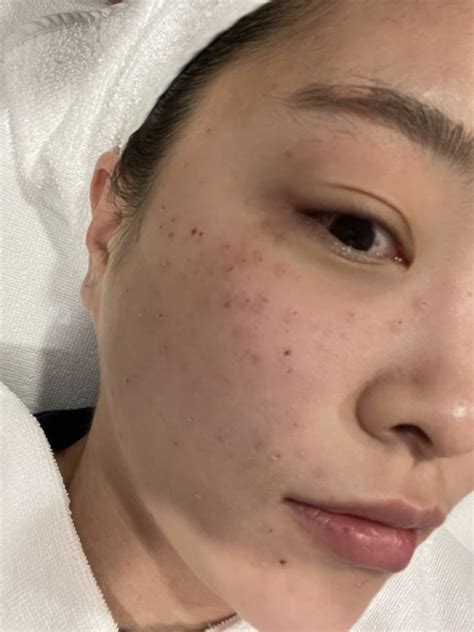 출산 후 드디어 편평사마귀 얼굴전체 제거하고 왔다 보톡스랑 비타민d 52만원에 했음 명동 네이버 블로그