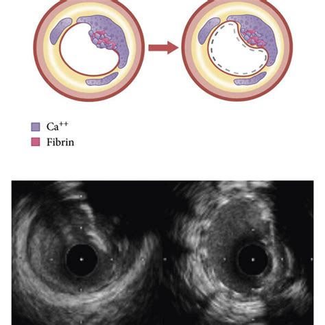 Central Illustration Drawing And Ivus Results Pre And Post Stent