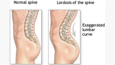Lumbar Lordosis Correction