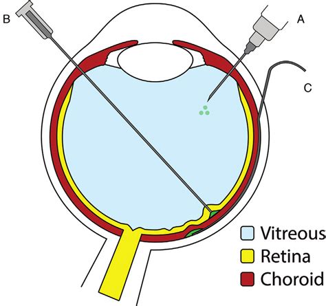 Ocular Gene Therapy Delivery Can Be Accomplished By Direct Intravitreal Download Scientific