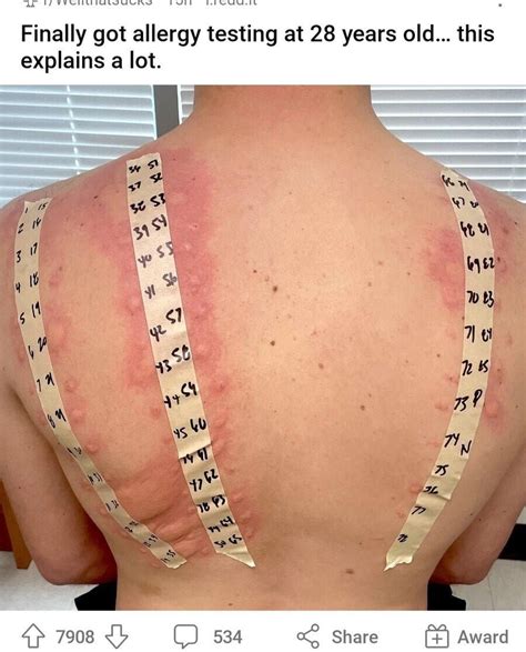 28세에 처음 알러지 검사한 사람 에누리 쇼핑지식 자유게시판
