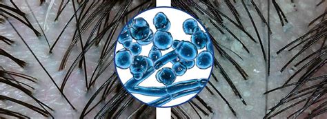 Scalp Microbiome Gets To The Root Of Dandruff Research Outreach