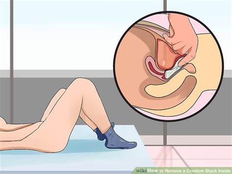 3 Ways To Remove A Condom Stuck Inside WikiHow