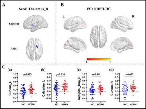 Fc Analysis From Right Thalamus To The Whole Brain Voxels In Ndph And