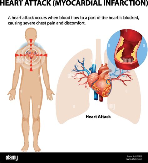 Illustration Of Heart Attack Symptoms And Blocked Arteries Stock Vector