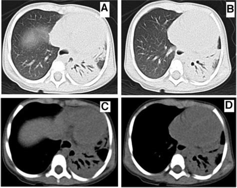 Frontiers An Unusual Presentation Of Necrotizing Pneumonia Caused By