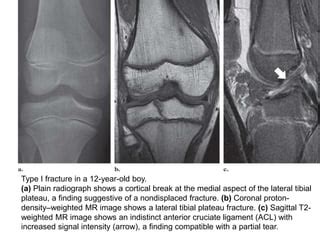 Tibial Plateau Fracture Mri
