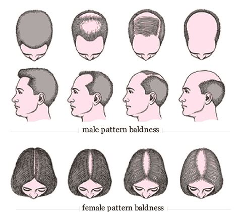 Baldness Archives Wellness Guide