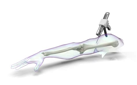 Flexible Hydrated Materials For Bone Defect Repair Loop Design Awards