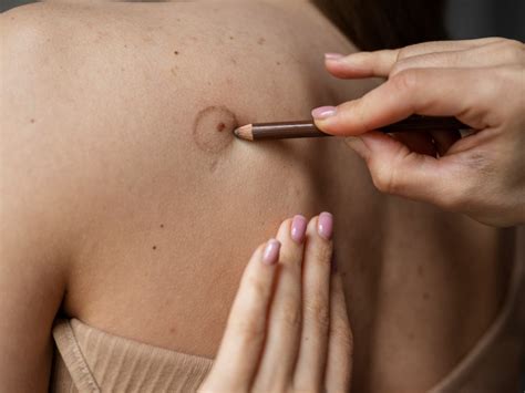 Top Scar Reduction Treatments In Mumbai Dermexperia