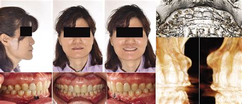 Maxillary Exostosis Treatment