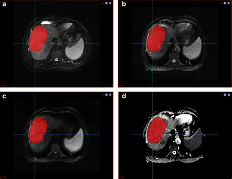 an example of the tumor voi for different mri sequences the voi was