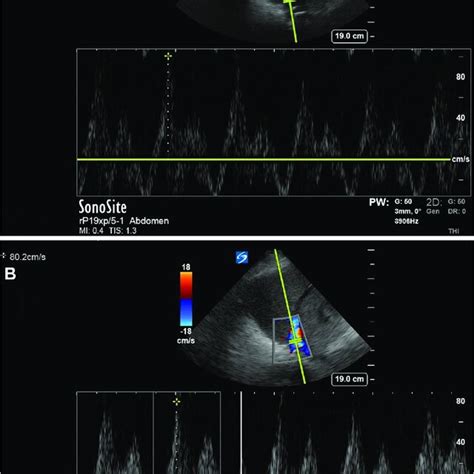 Two Dimensional Tte Pocus Pulsed Wave Pw Doppler Spectrum Without