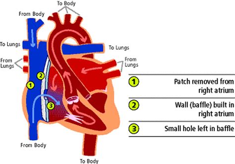 Fontan Procedure Uses Types Recovery And Complications
