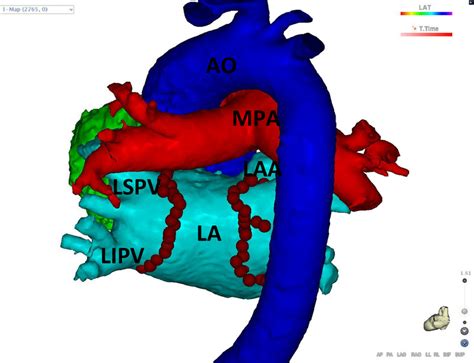 A Map Outlining The Relationship Between Extracardiac And La Structures
