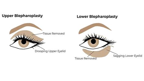 Blepharoplasty A Complete Understanding Of Eyelid Surgery