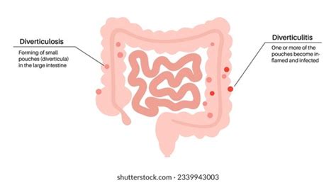 Diverticulitis Diverticulosis Diseases Diverticula Walls Intestine Stock Vector Royalty Free