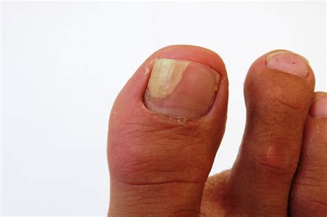 Why Does Toenail Fungus Smell