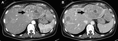 Imaging Of Gastrointestinal Stromal Tumors From Diagnosis To
