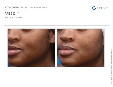 Moxi Laser Fractional Skin Resurfacing Treatment Hanover Ma Alda Aesthetics